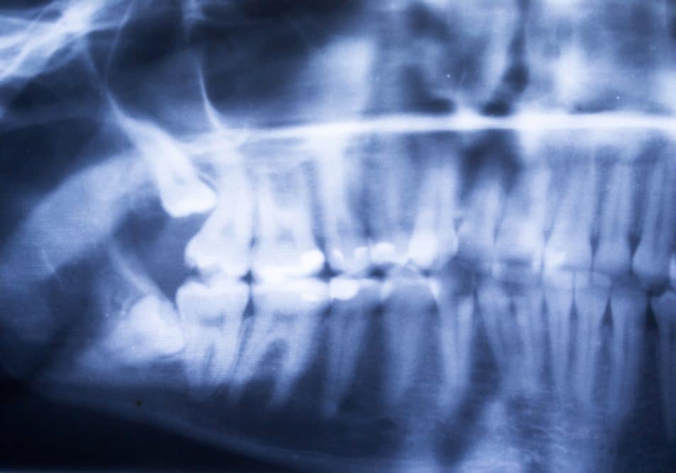Wisdom Teeth Removal Marin County, CA : Marin Contemporary Perio ...