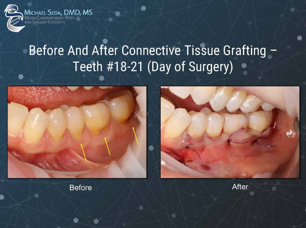 Soft Tissue Grafting Cases