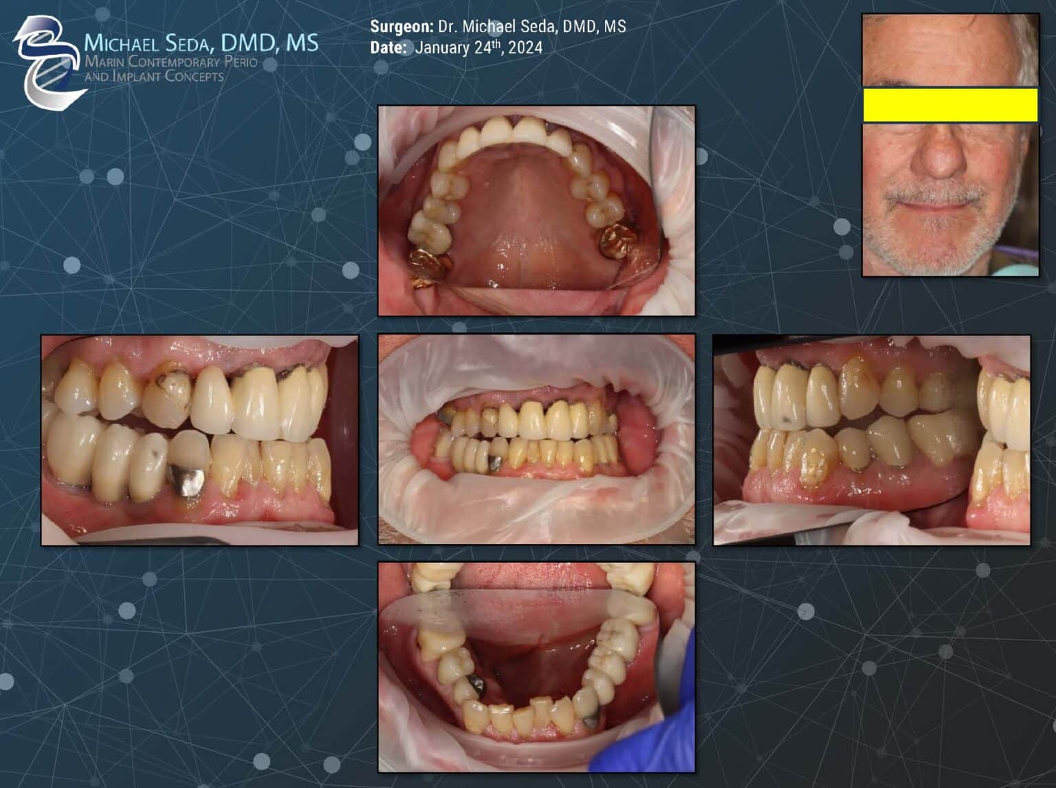 Ridge Augmentation Implant Cases