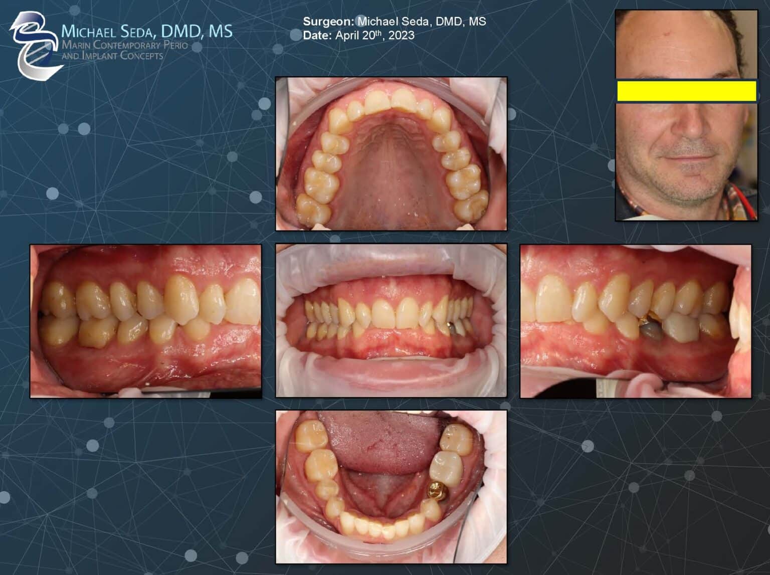 Regeneration of Bone around Teeth Cases